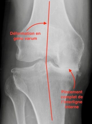 Arthrose du genou (gonarthrose) - Dr SIMIAN, Périgueux