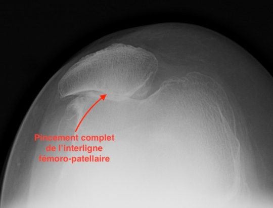 Arthrose du genou (gonarthrose) - Dr SIMIAN, Périgueux
