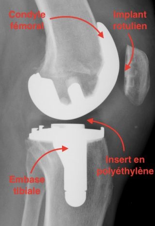 Prothèse Totale de Genou (PTG) - Dr SIMIAN, Périgueux