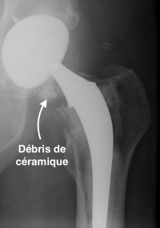 Fracture de céramique d'une prothèse de hanche - Dr SIMIAN, Périgueux