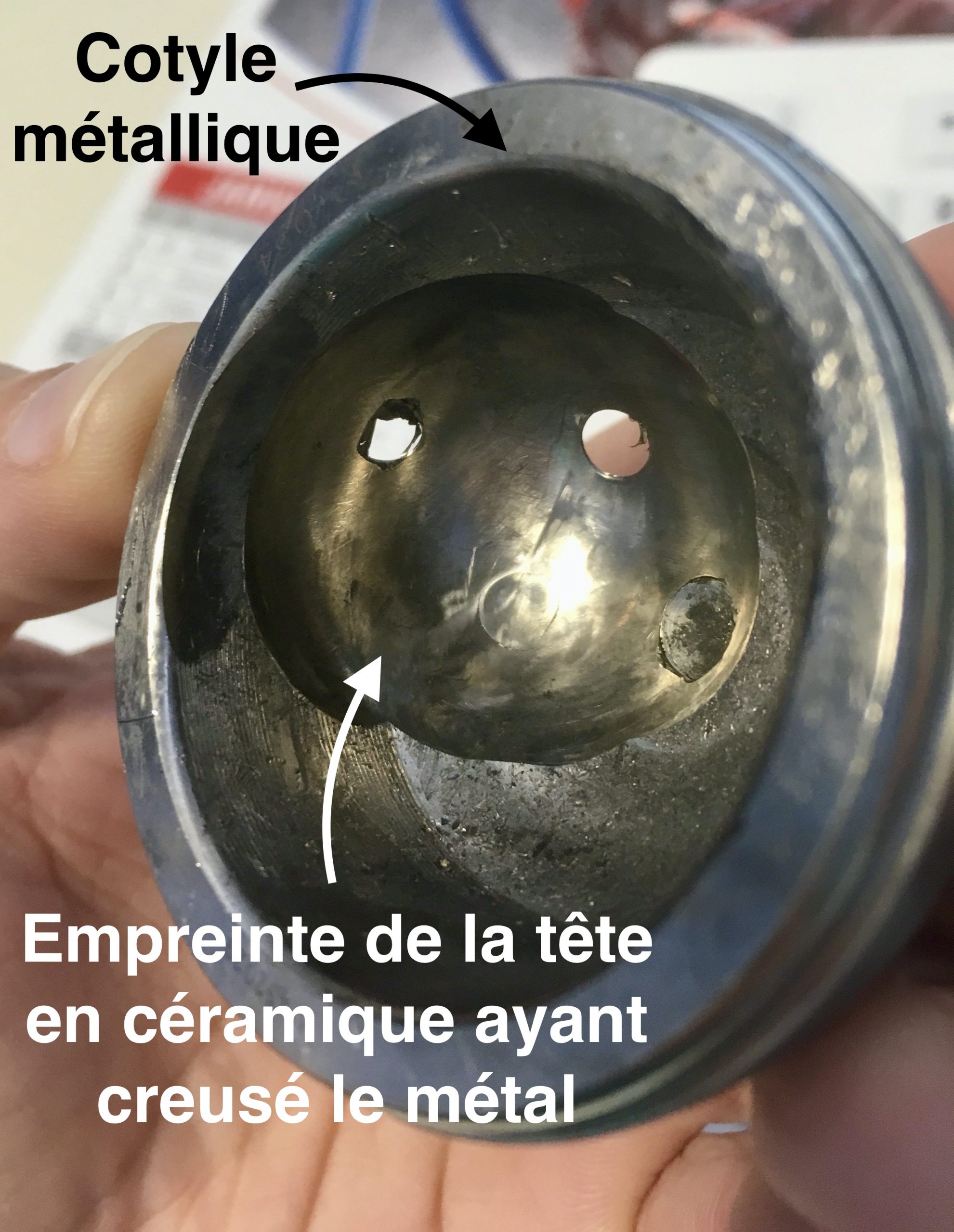 Fracture de céramique d'une prothèse de hanche - Dr SIMIAN, Périgueux