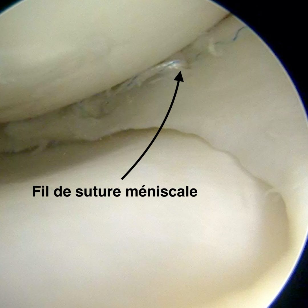 Suture Du Ménisque Dr Simian Périgueux Dordogne