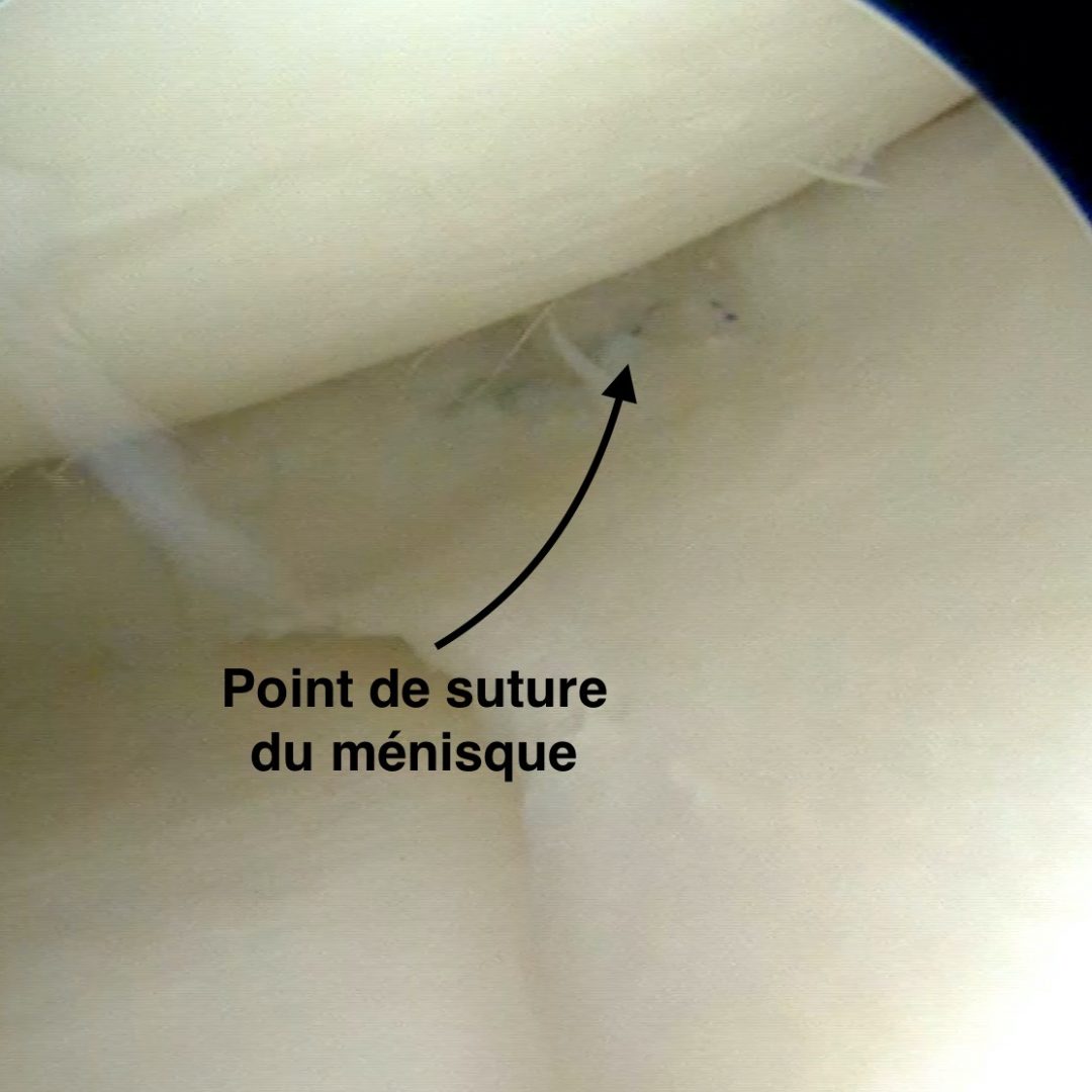 Suture Du Ménisque Dr Simian Périgueux Dordogne