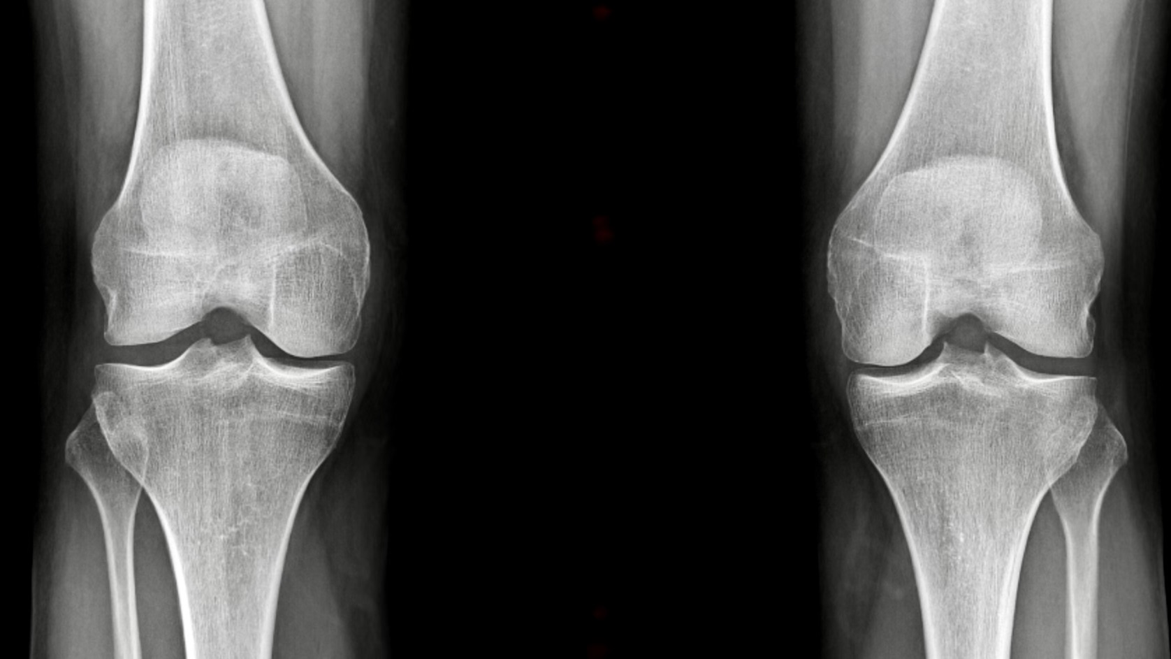 Chirurgie du genou - Dr SIMIAN, Périgueux