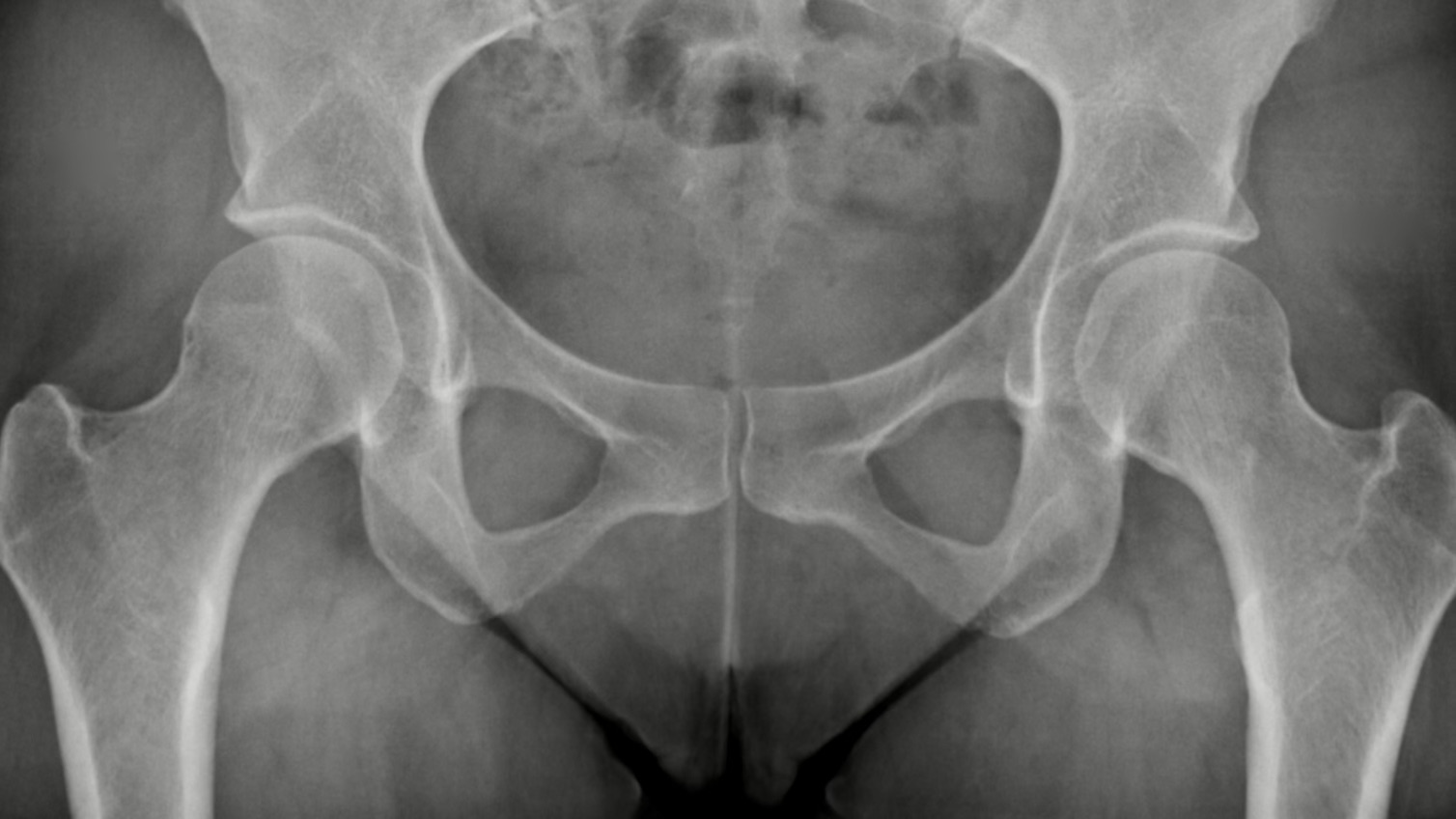 Chirurgie de la hanche - Dr SIMIAN, Périgueux